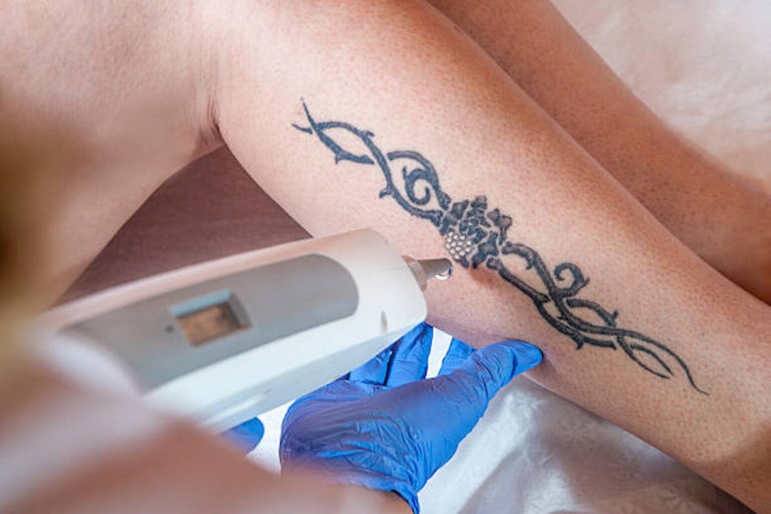 A Glimpse Of The Tattoo Removal Procedure